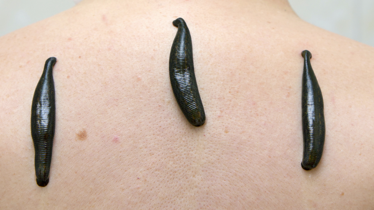 Leeches for atopic dermatitis – how can they help? - Euro-BION